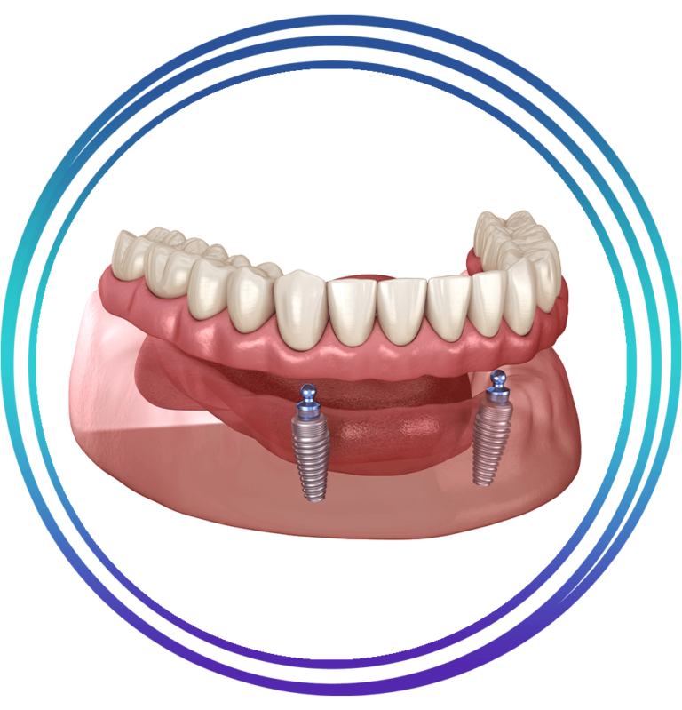 Full Mouth Dental Implants | Implant Center of Montana | Missoula, MT